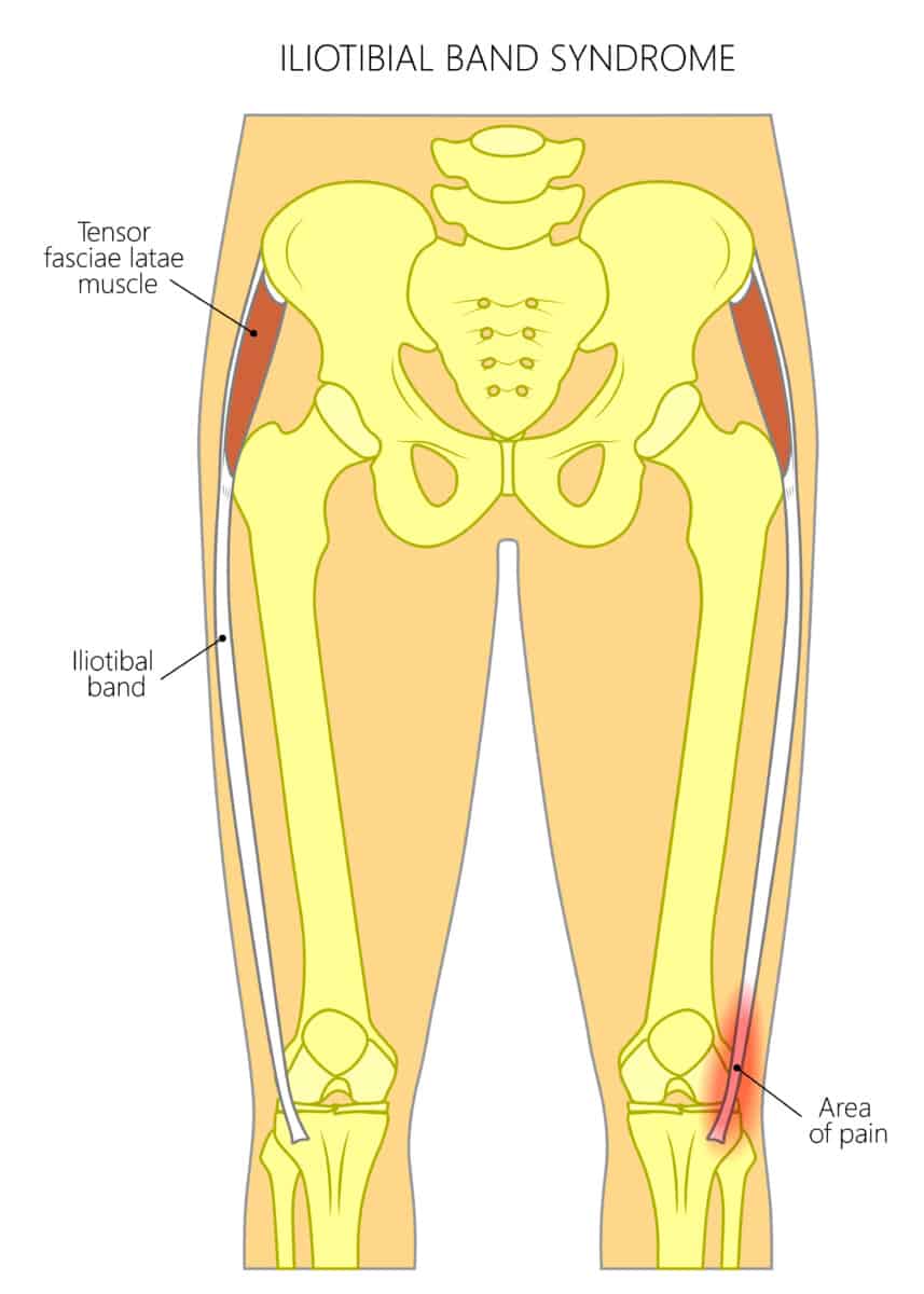IT Band Syndrome | IT Band Syndrome Symptoms, Causes and Massage
