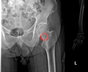 Hip Stress Fracture: Symptoms, Causes, Diagnosis and Exercises