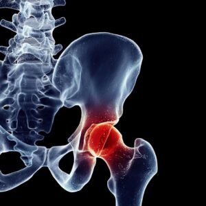 Perthes Disease - Advice and Treatment from a Physical Therapist