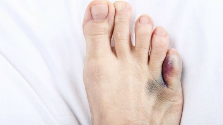Pinky Toe Pain - Learn the causes of Pain in your Little Toe