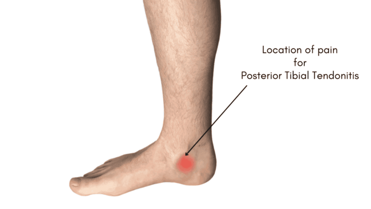 Posterior Tibial Tendonitis: Causes, Symptoms, and Treatment.