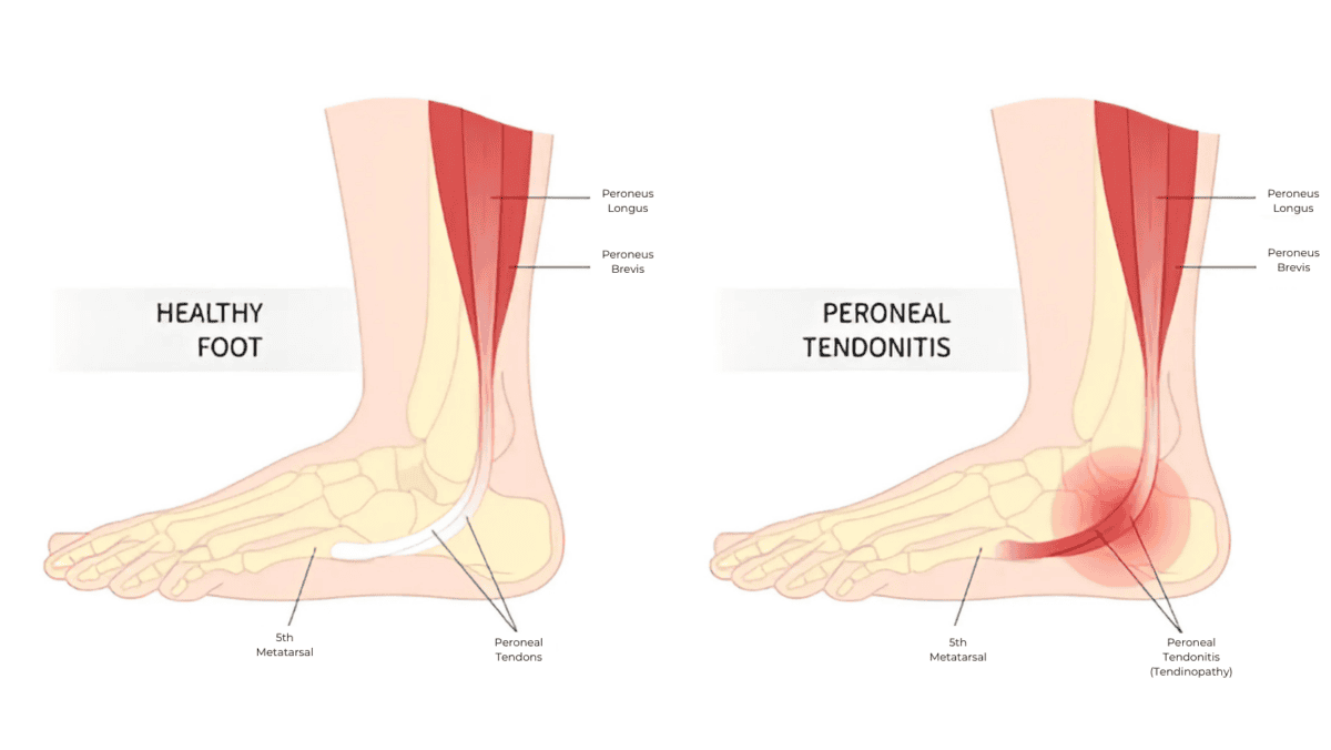 Peroneal Tendonitis: Key Symptoms and Best Treatment Options